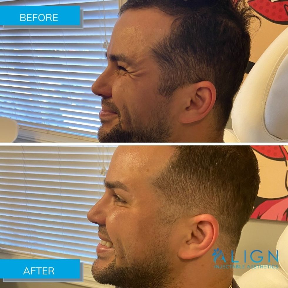 Before and After Cosmetic Injections at Align Injectable Aesthetics
